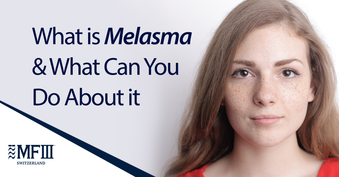 What is Melasma & What You Can Do About it - MF3 Malaysia
